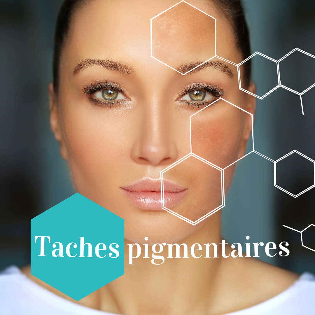 Taches sur la peau : traitement et prévention | Blogue Espace Doumandji